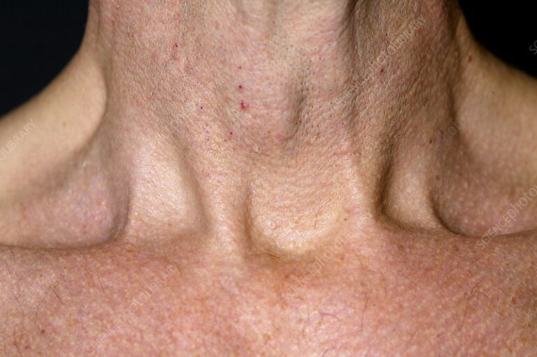 Thyroid Swelling – drjyotisurgeryclinic
